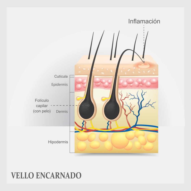 Razones por las que puedes tener 【VELLO FACIAL ENCARNADO】